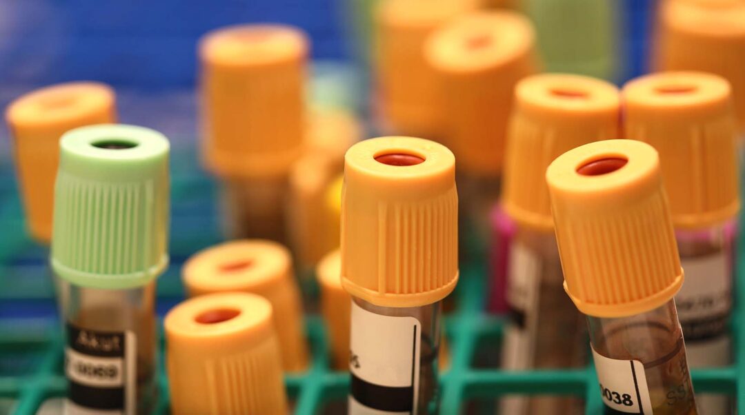 Vem prioriterar biobankerna? – Biobank Sverige